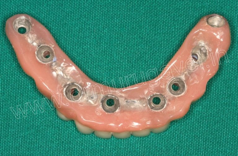 » MULTI UNIT BASAL IMPLANTS