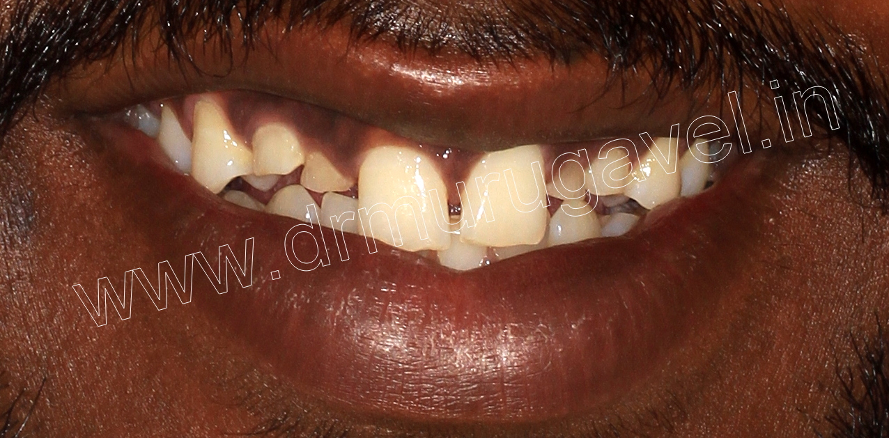 » Retained deciduous teeth extraction and immediate implant placement