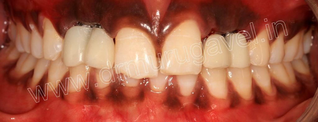 Retained deciduous teeth extraction and immediate implant placement ...