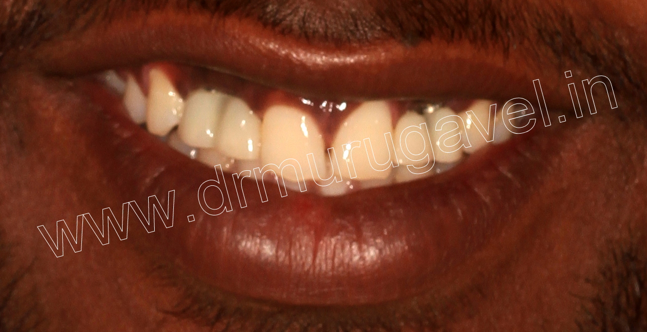 » Retained deciduous teeth extraction and immediate implant placement