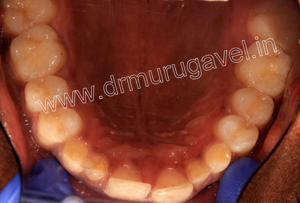 » Retained deciduous teeth extraction and immediate implant placement