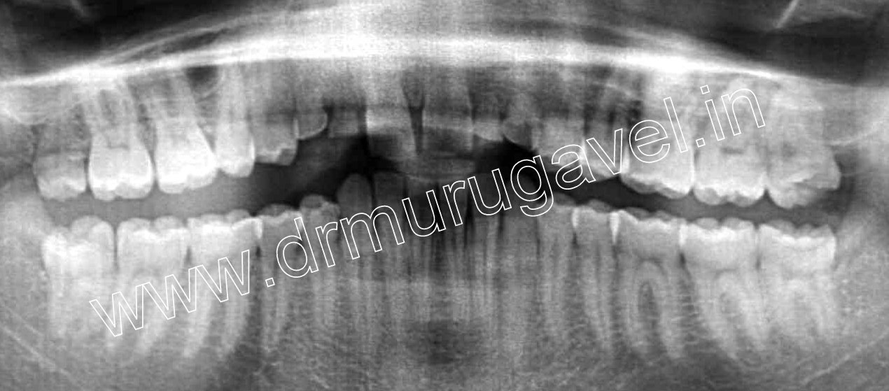 » Retained deciduous teeth extraction and immediate implant placement