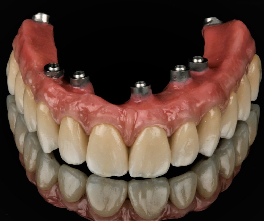 » Permanent Prosthesis for Implants