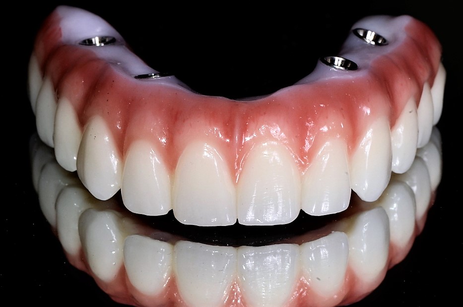 » Permanent Prosthesis for Implants