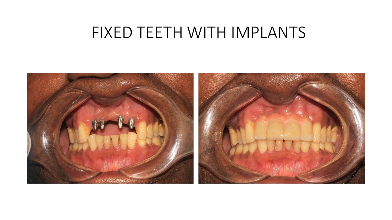 » Fixed teeth in 3 Days